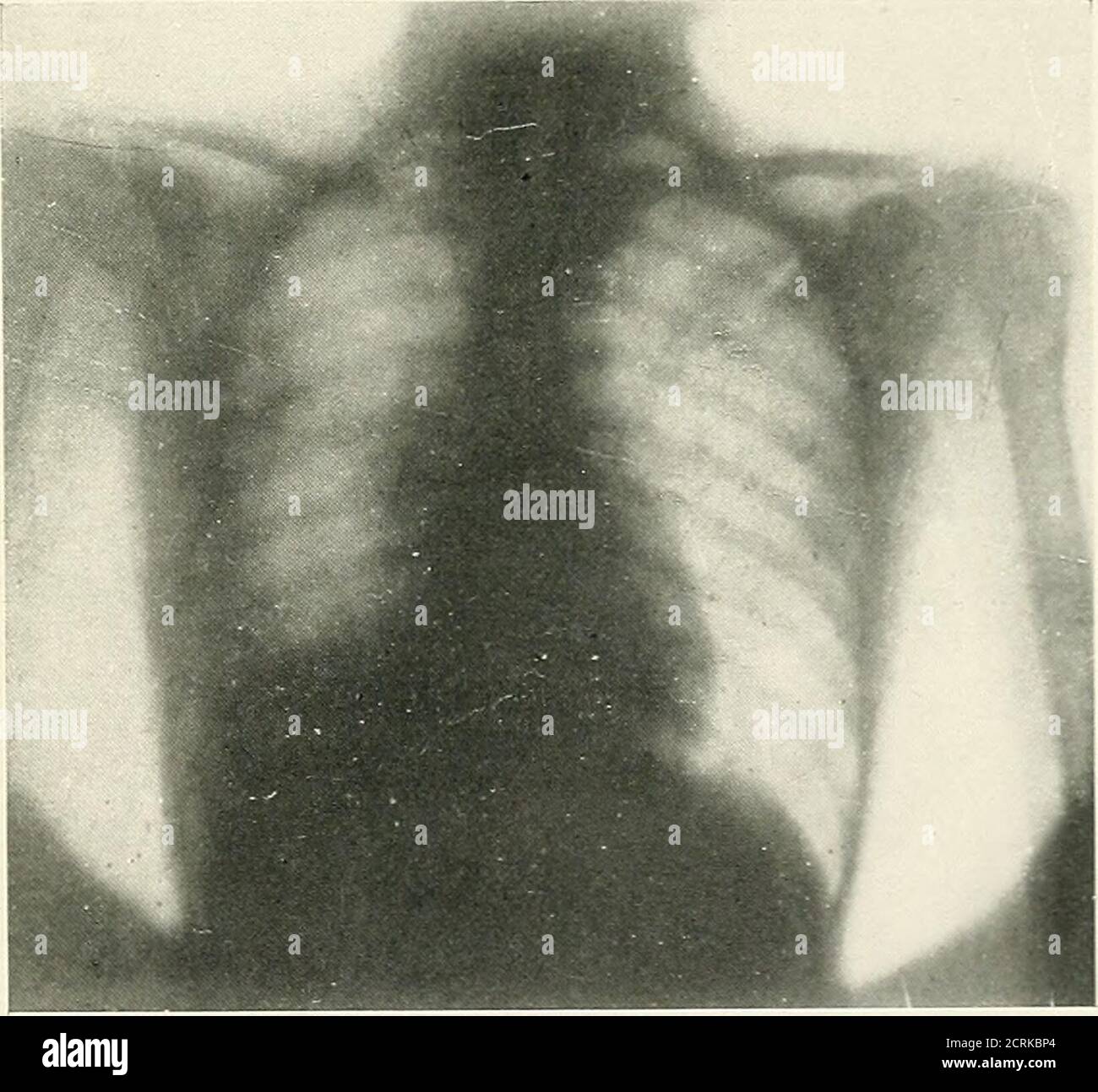 . Radio-diagnosis of pleuro-pulmonary affection . Radiograph 1 ...