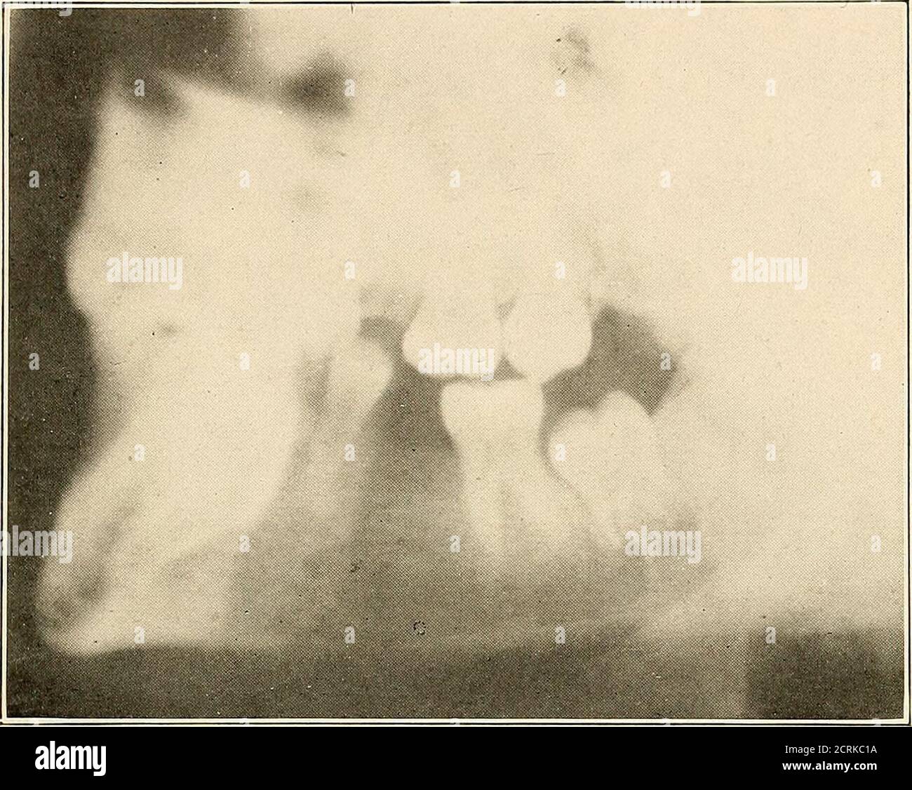 . Interpretation of dental & maxillary roentgenograms . Fig. 251.—Root ...