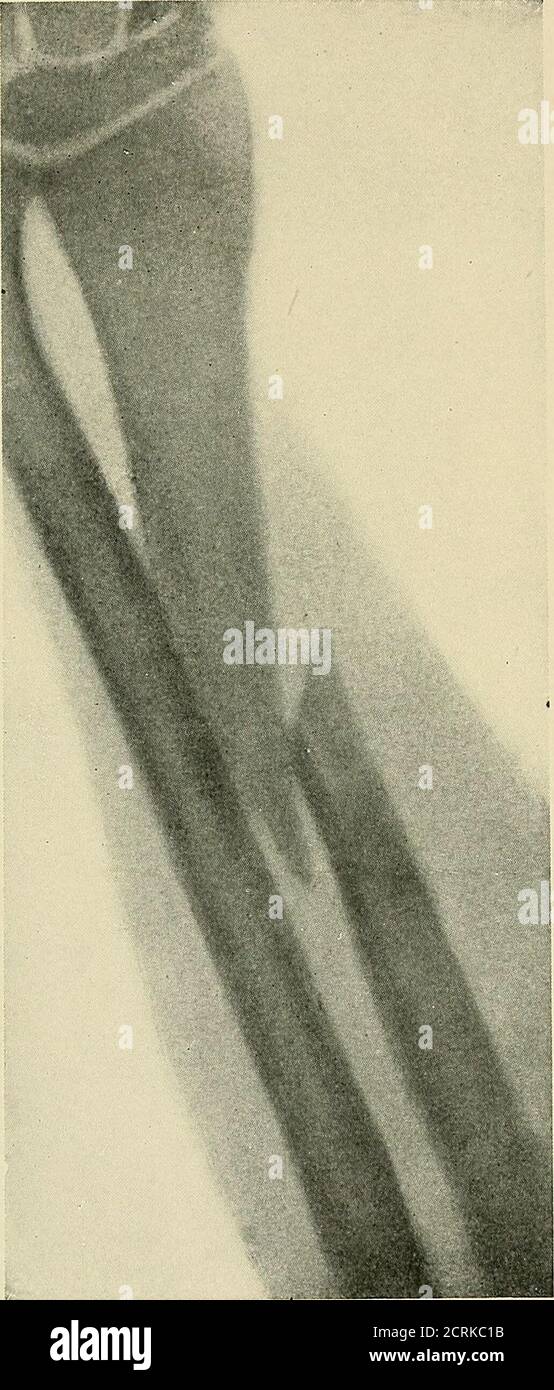 Left arm in plaster hi-res stock photography and images - Alamy