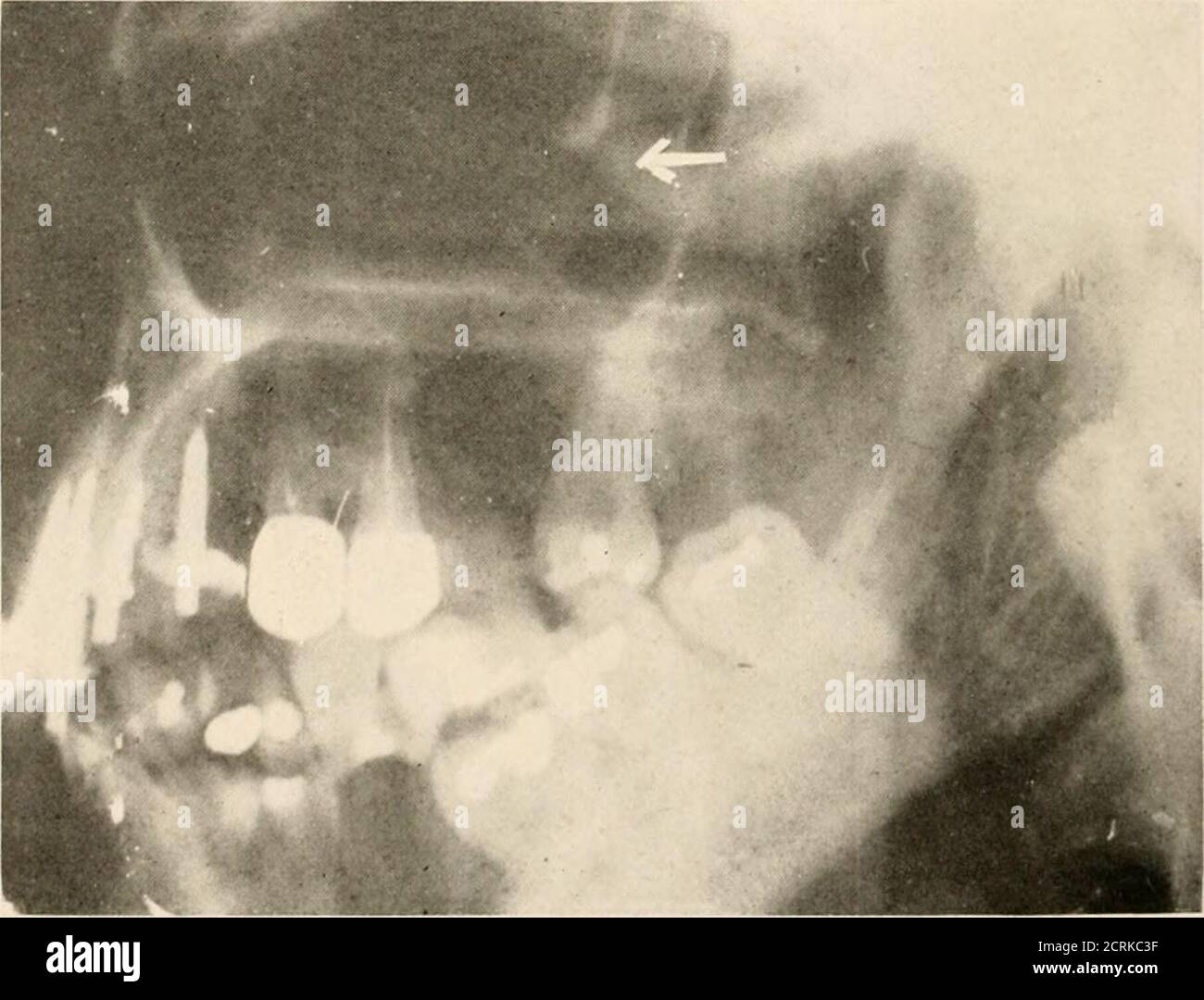 . Interpretation of dental & maxillary roentgenograms . Fig. 250.—Root ...