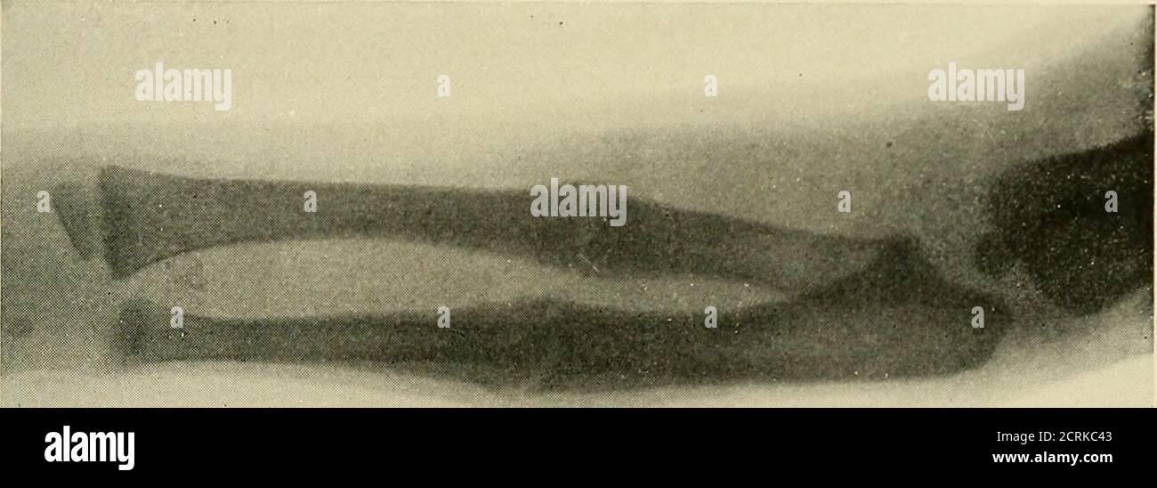 . Röntgen ray diagnosis and therapy . Fig. 148.—Fracture of Both Bones ...