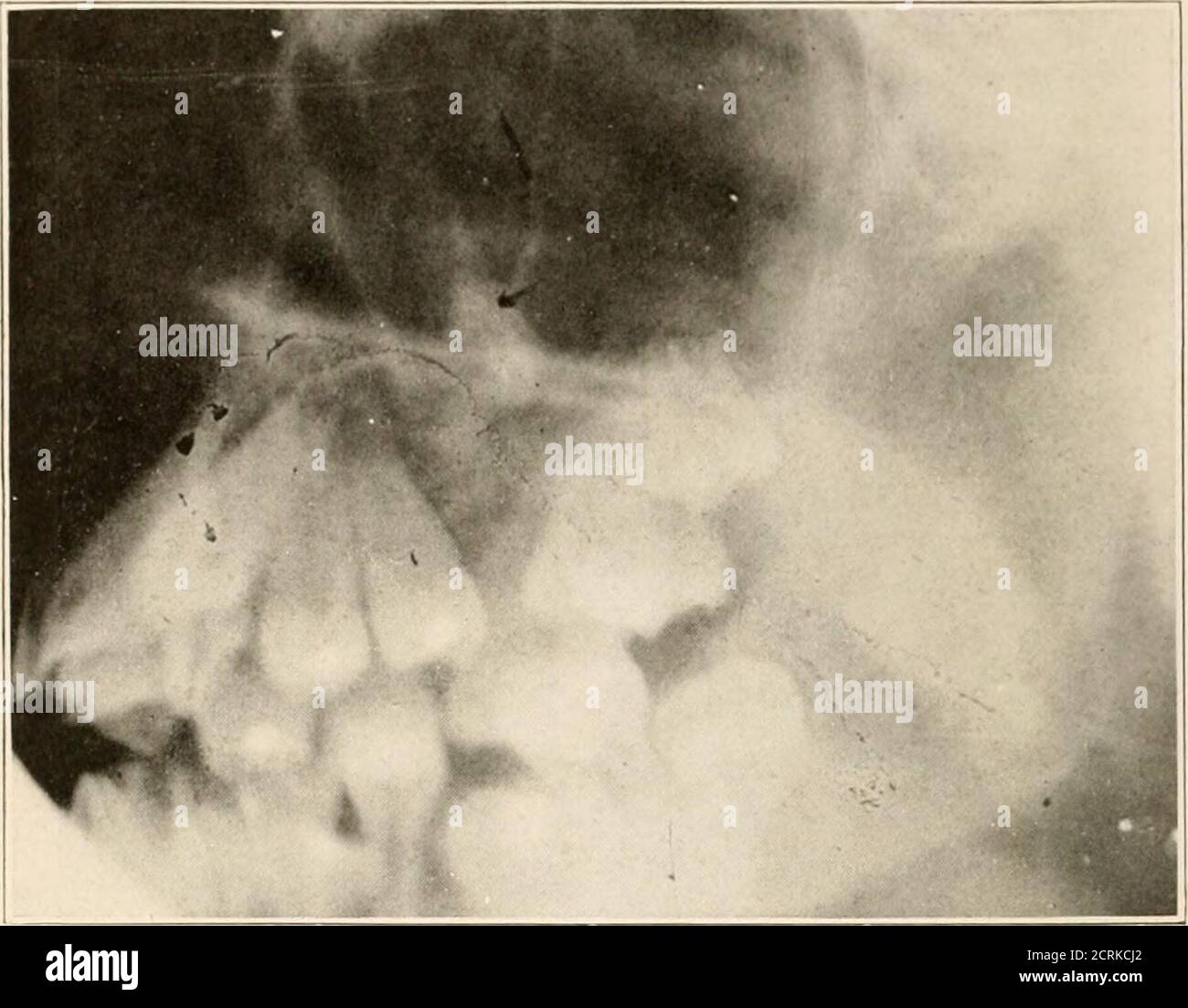 . Interpretation of dental & maxillary roentgenograms . Fig. 249 ...