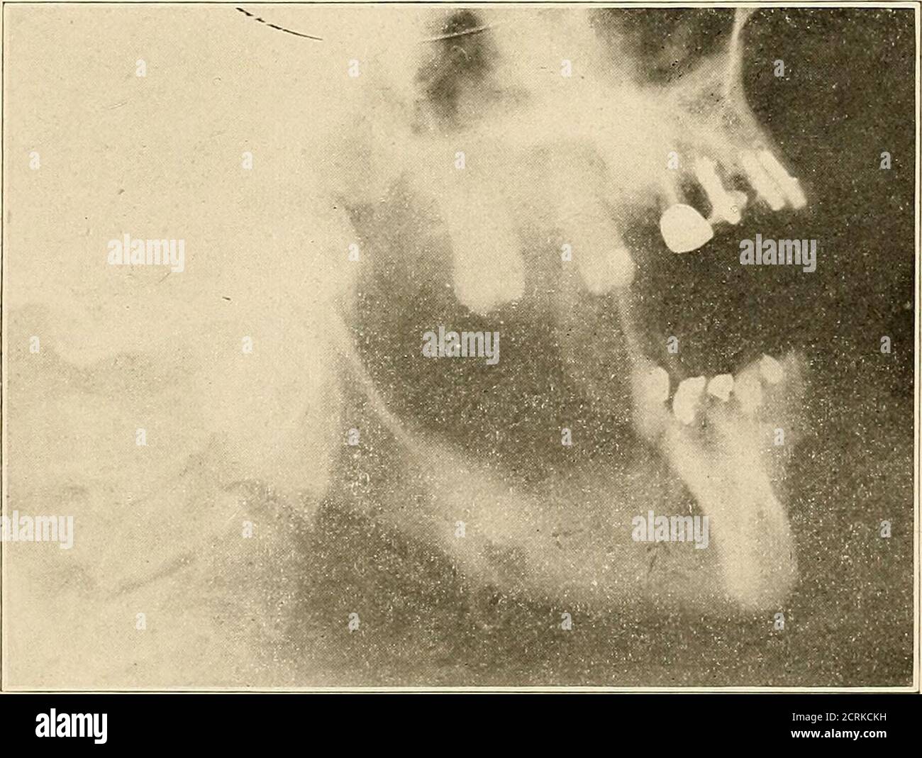 . Interpretation of dental & maxillary roentgenograms . Fig. 248 ...