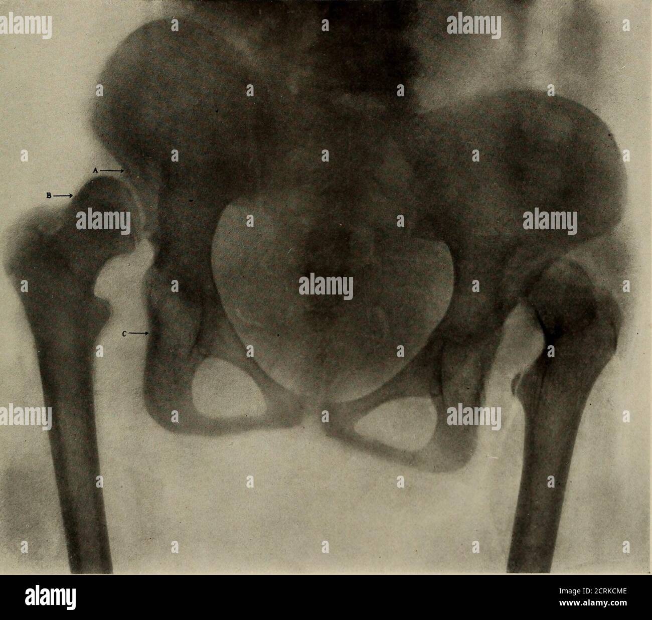 Congenital dislocation of the hip hi-res stock photography and images ...