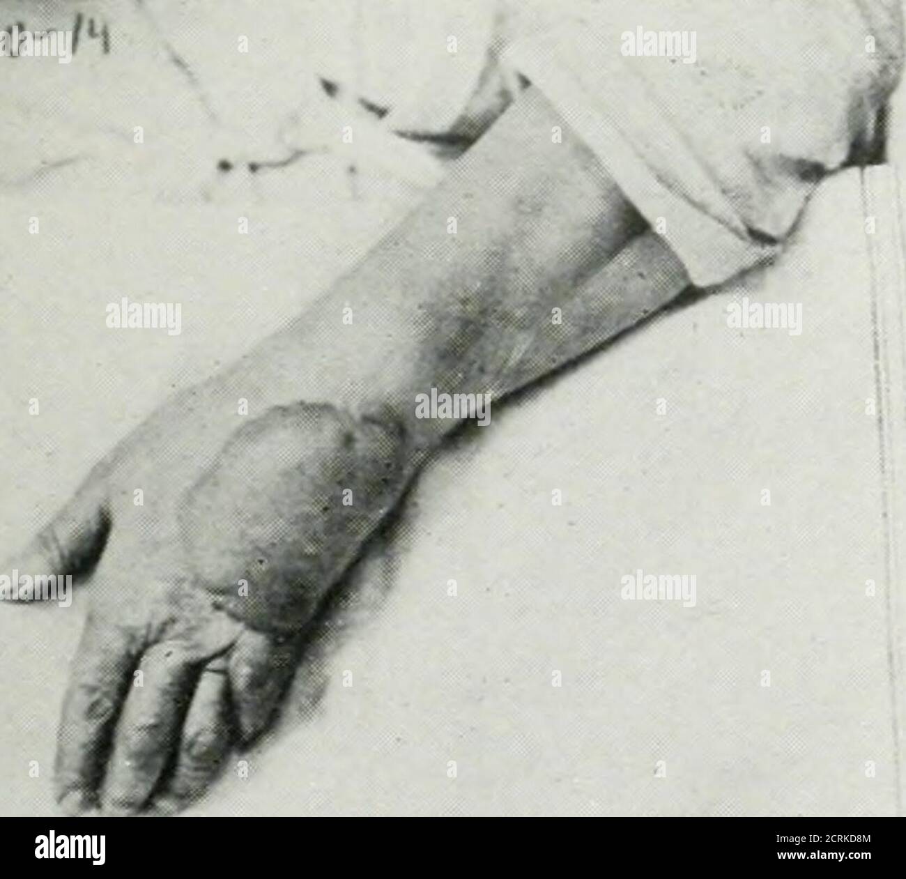 Lip Tumor High Resolution Stock Photography and Images - Alamy