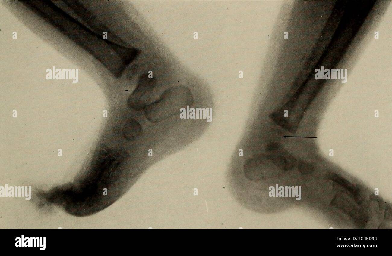 Congenital dislocation of the hip hi-res stock photography and images ...