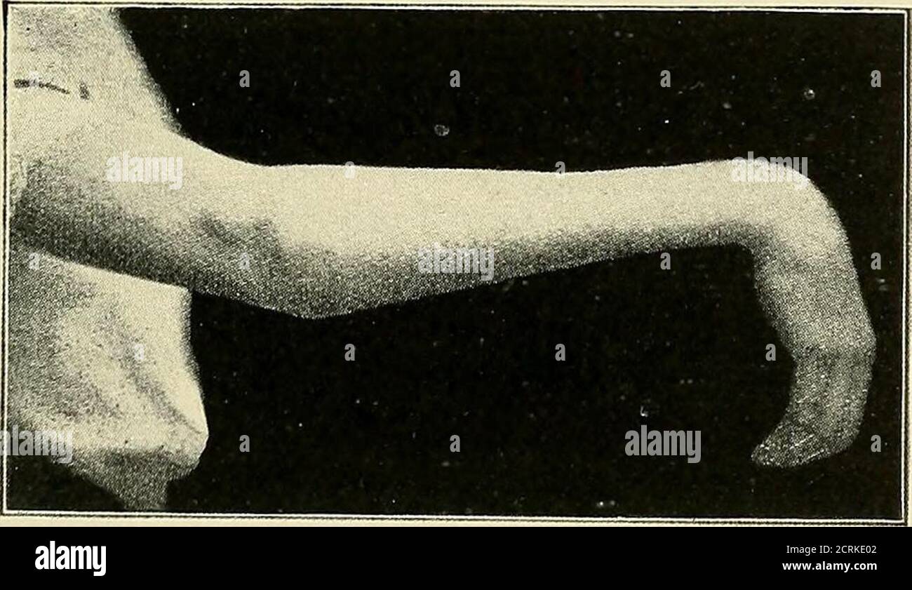 . Röntgen ray diagnosis and therapy . Fig. 142.—Old Fractoke of Ex ...