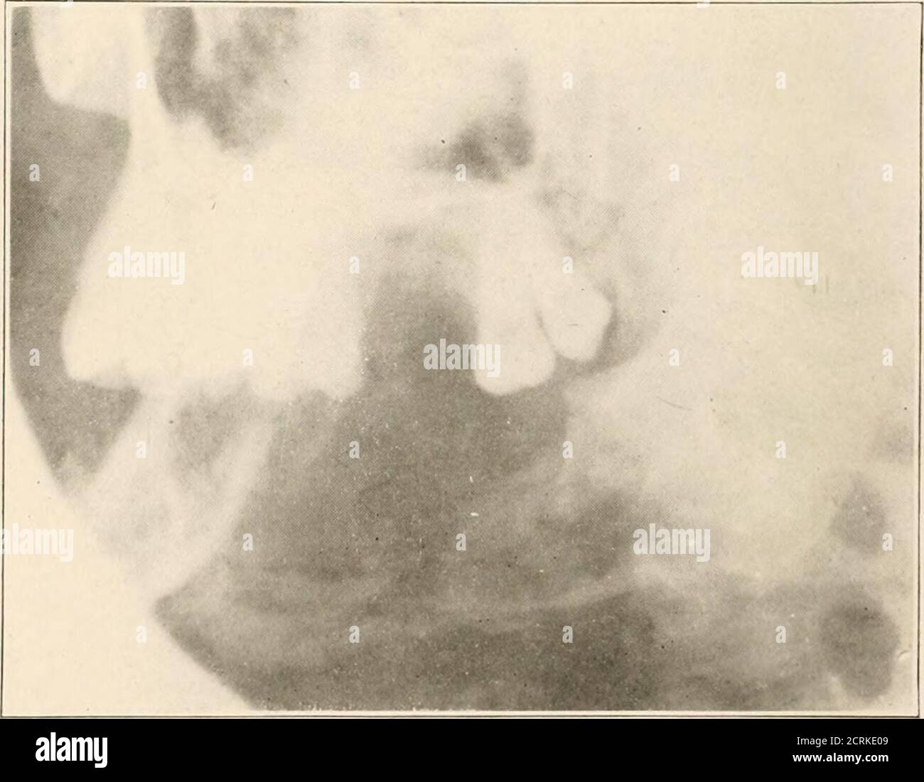 . Interpretation of dental & maxillary roentgenograms . A. B. Fig. 241 ...