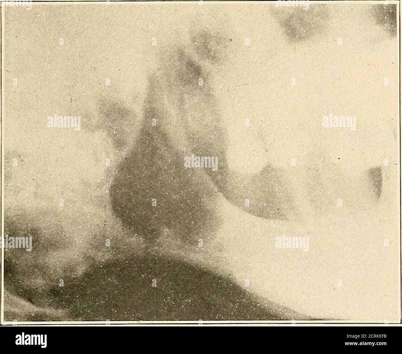 Ramus of mandible hi-res stock photography and images - Alamy