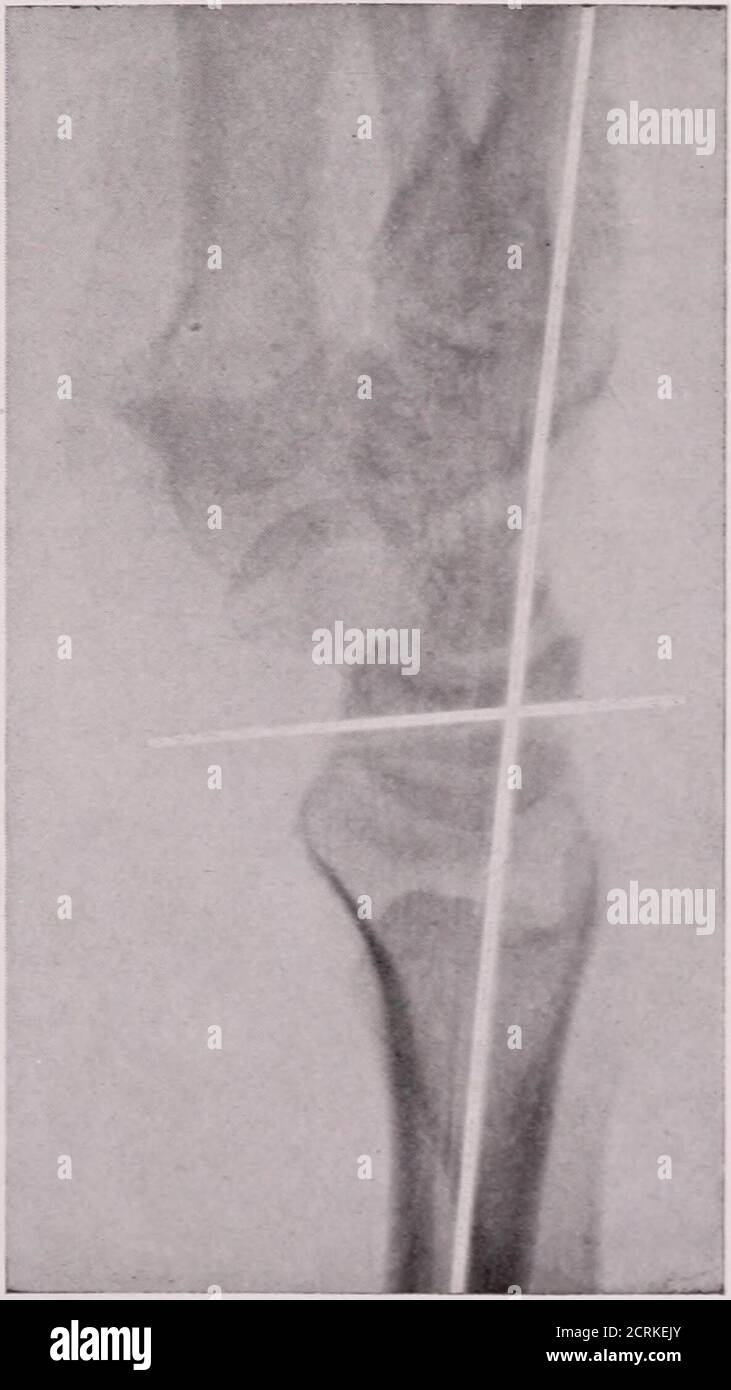 Styloid fracture hi-res stock photography and images - Alamy