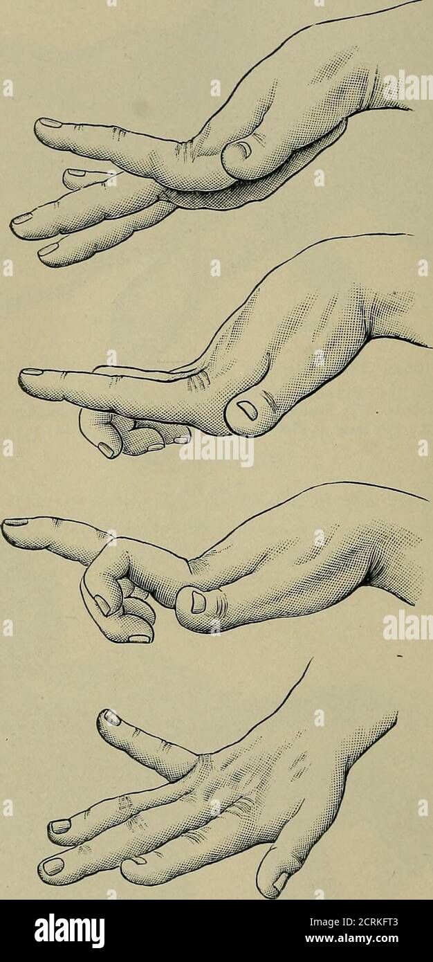 Chronic inflammation of muscles and joints hi-res stock photography and ...