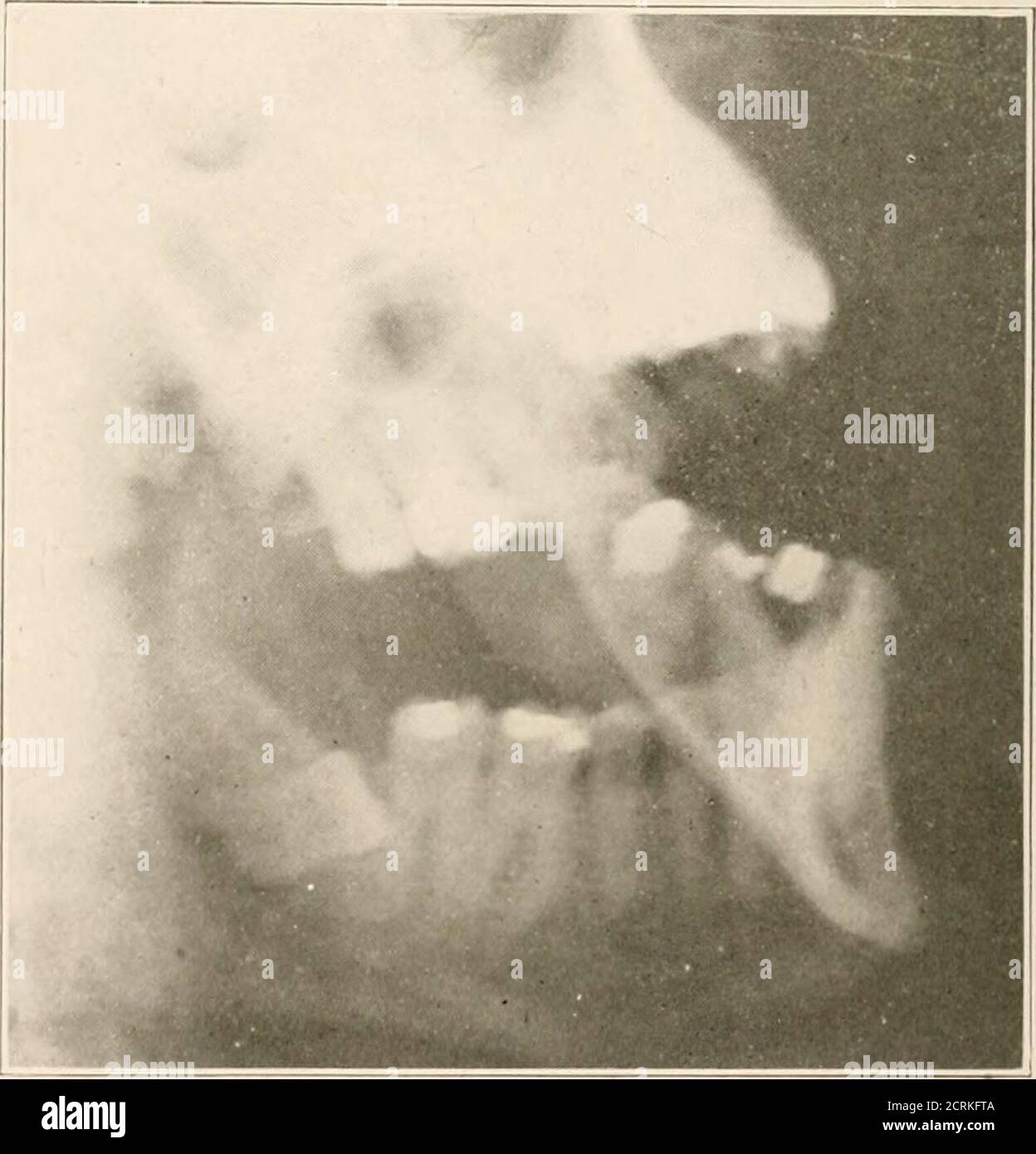 . Interpretation of dental & maxillary roentgenograms . Fig. 233 ...