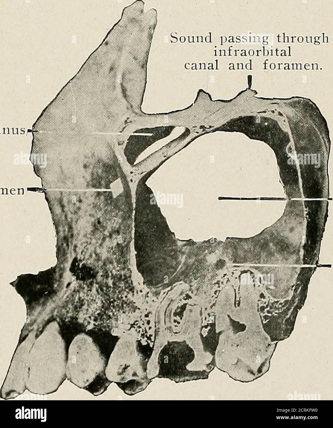 Infraorbital foramen hi-res stock photography and images - Alamy