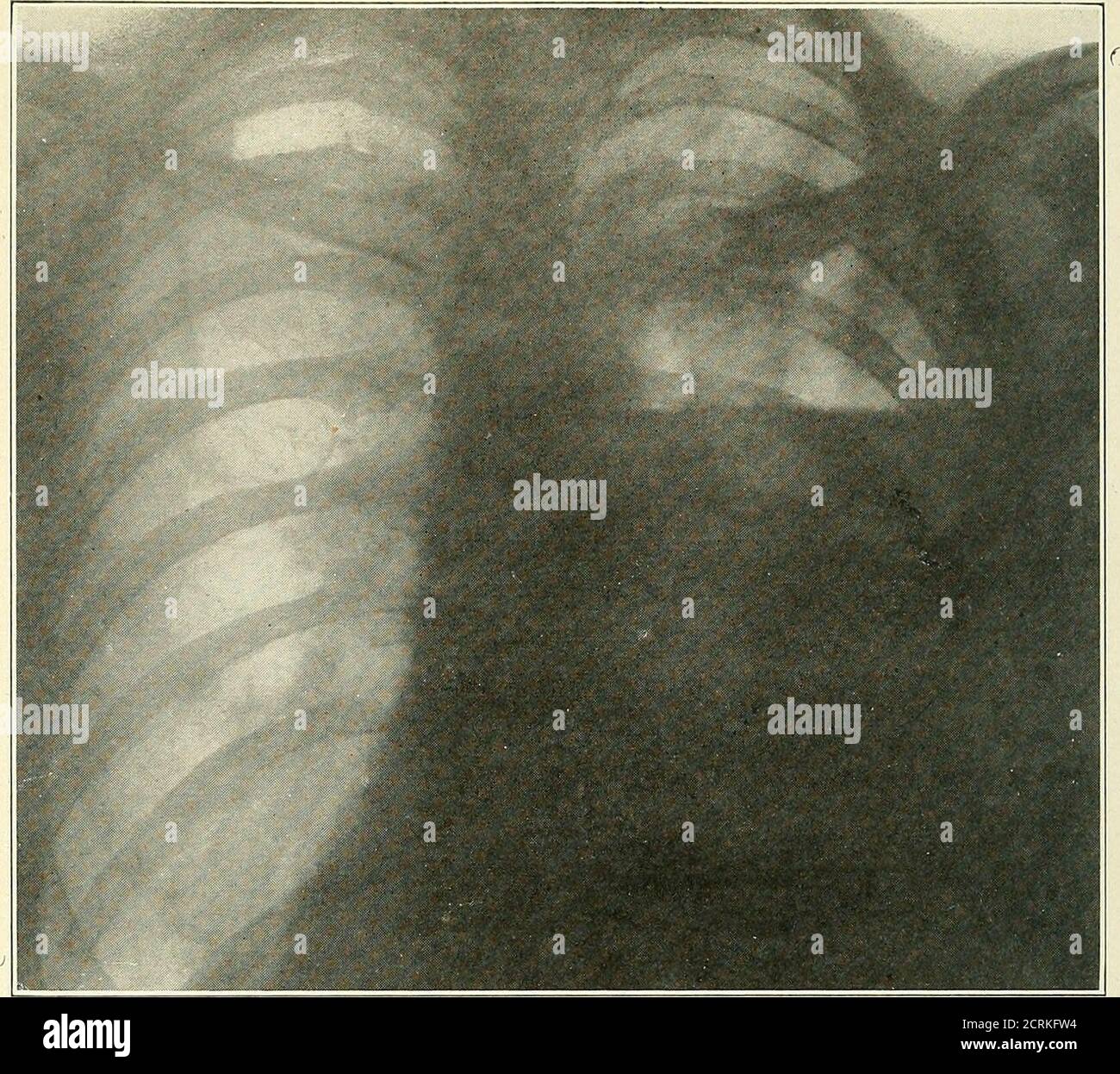 Complete collapse hi-res stock photography and images - Alamy