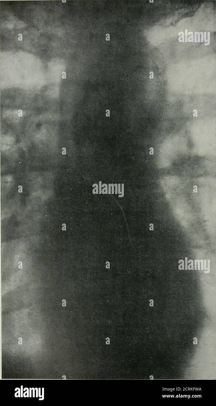 Dorn method hi-res stock photography and images - Alamy