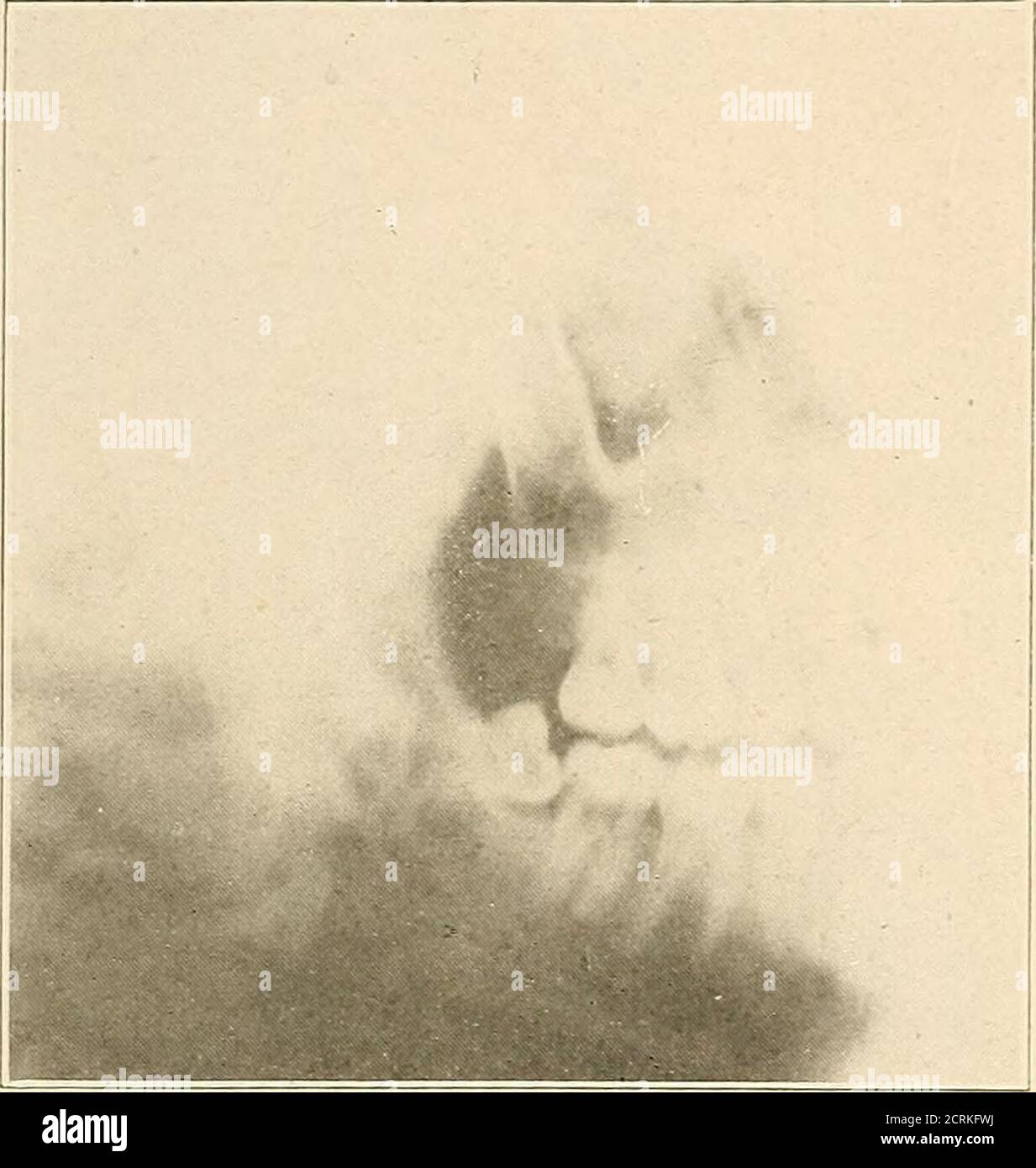 . Interpretation of dental & maxillary roentgenograms . Fig. 234 ...