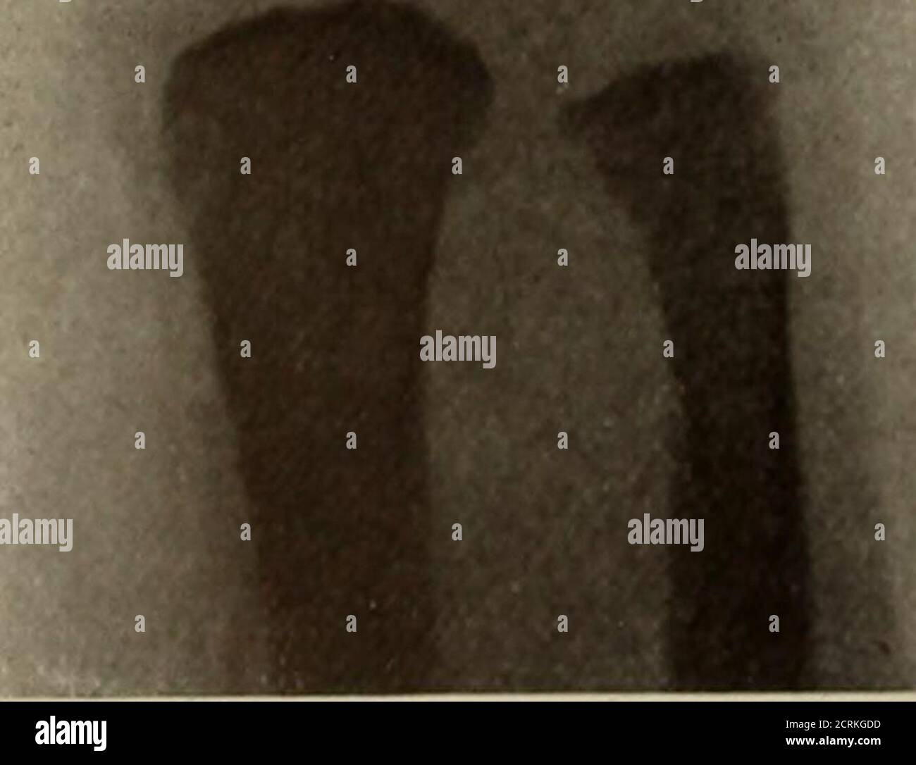 Congenital deformity of the hands hi-res stock photography and images ...