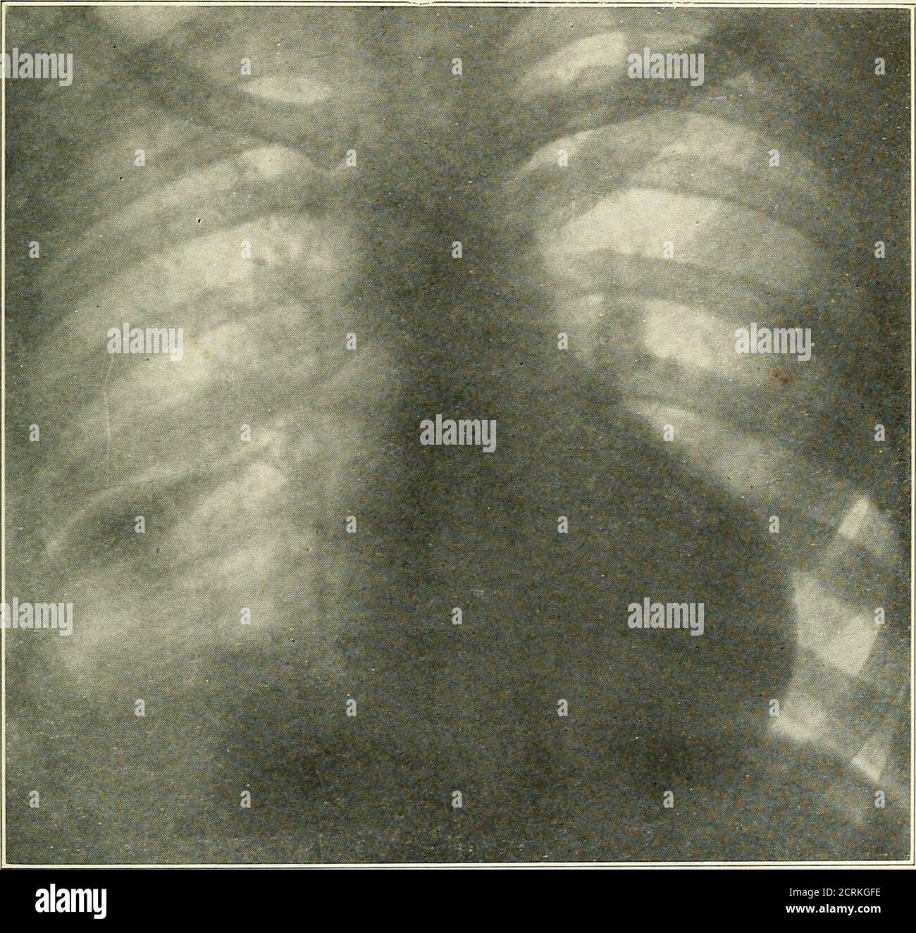 Subphrenic abscess hi-res stock photography and images - Alamy