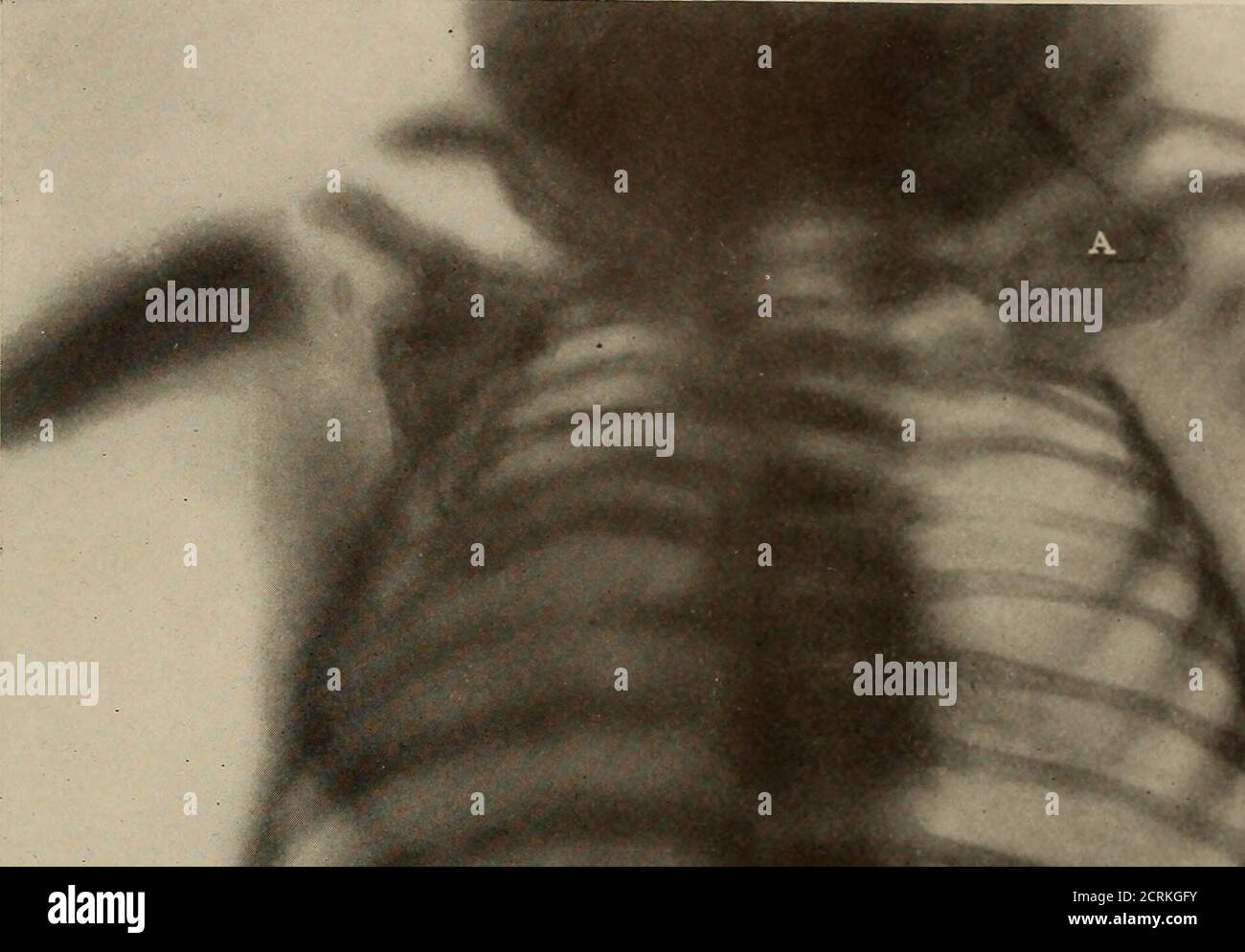 . Living anatomy and pathology; . / PLATE 49.CONGENITAL ELEVATION OF ...