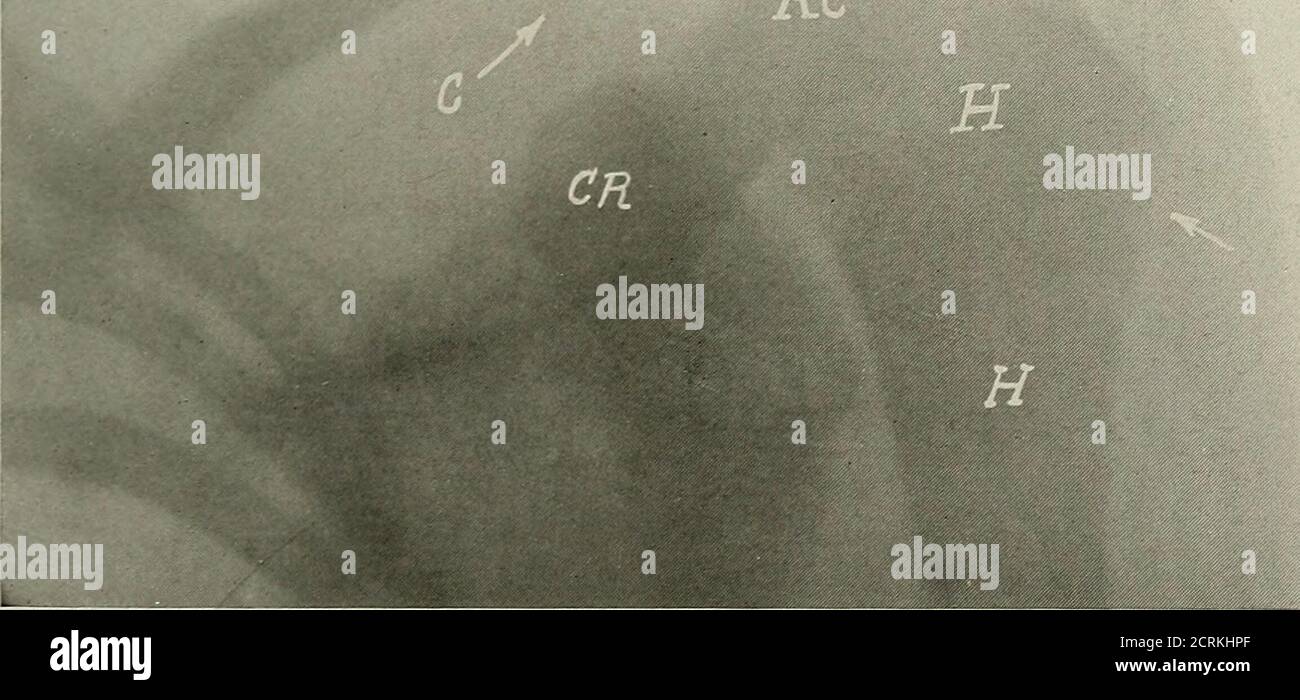 . Röntgen rays and electro-therapeutics : with chapters on radium and ...
