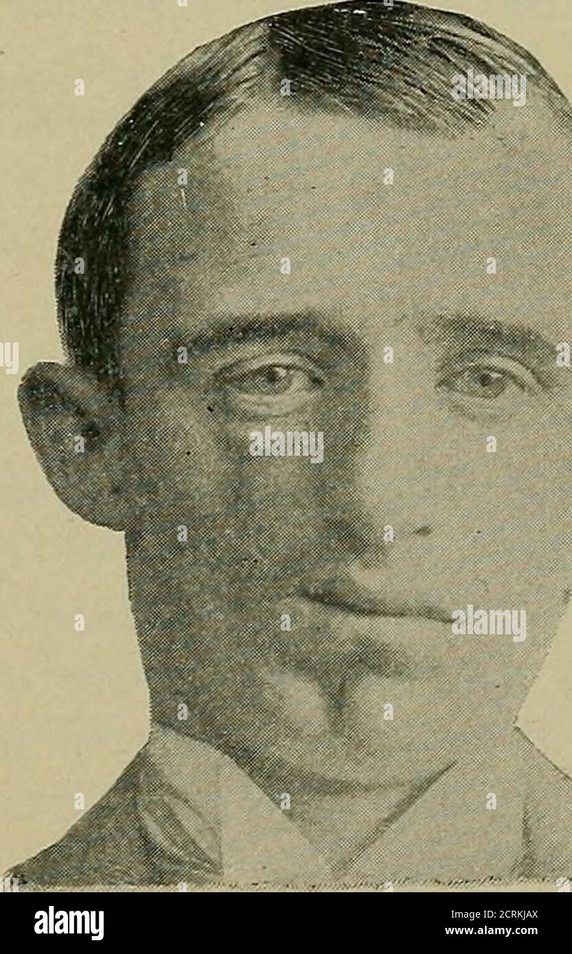 Facial hemiatrophy hi-res stock photography and images - Alamy