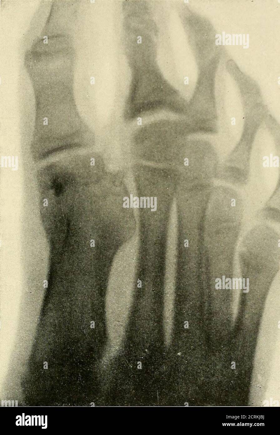 . Röntgen ray diagnosis and therapy . n the detection of foreign bodies ...