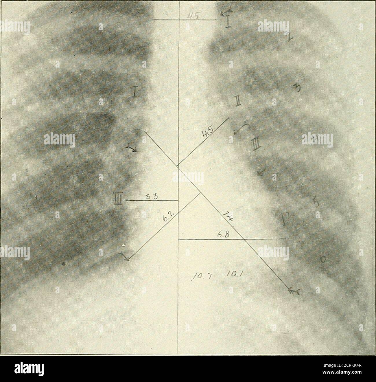 Dermoid cysts hi-res stock photography and images - Alamy