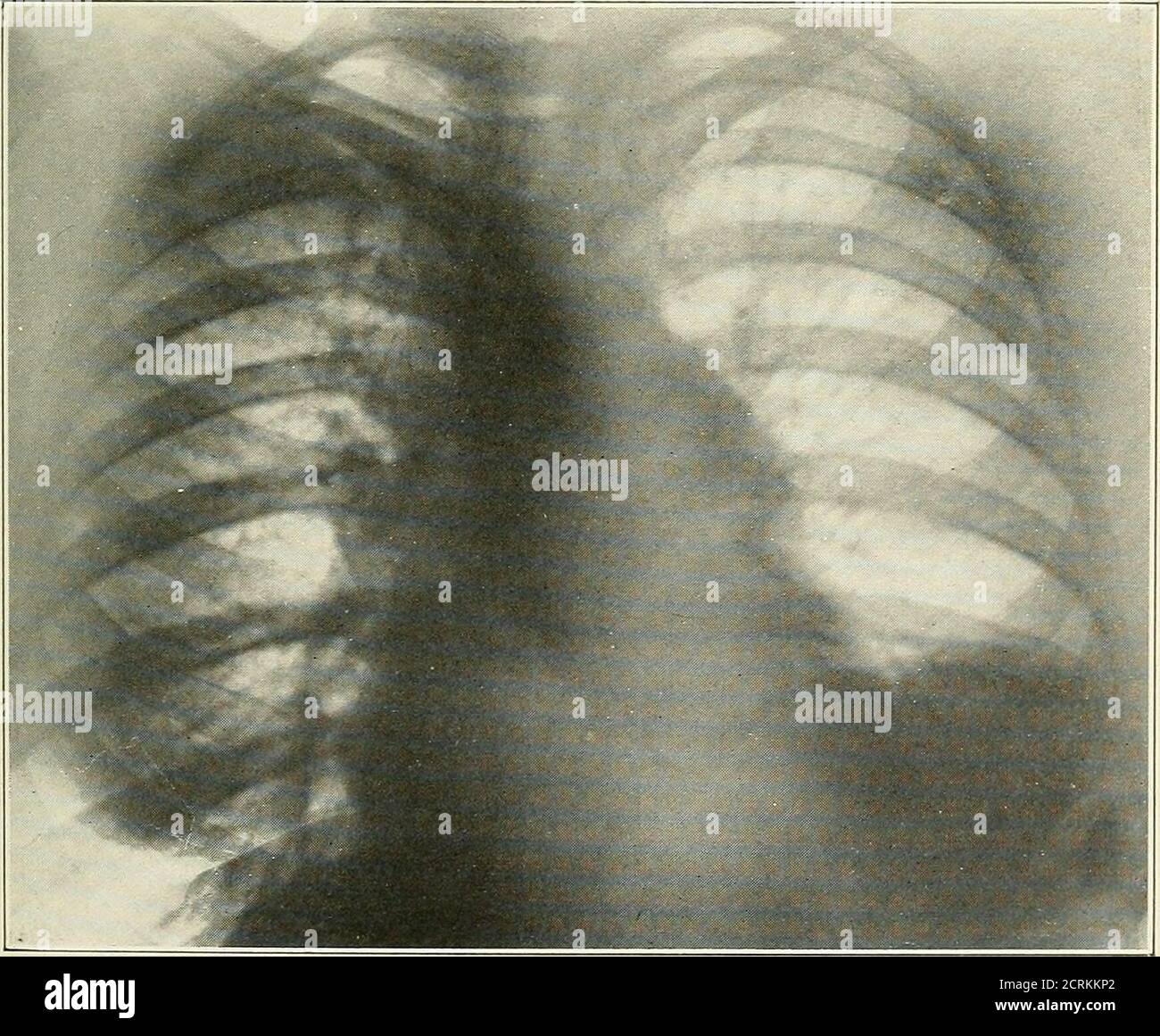 Dermoid cysts hi-res stock photography and images - Alamy