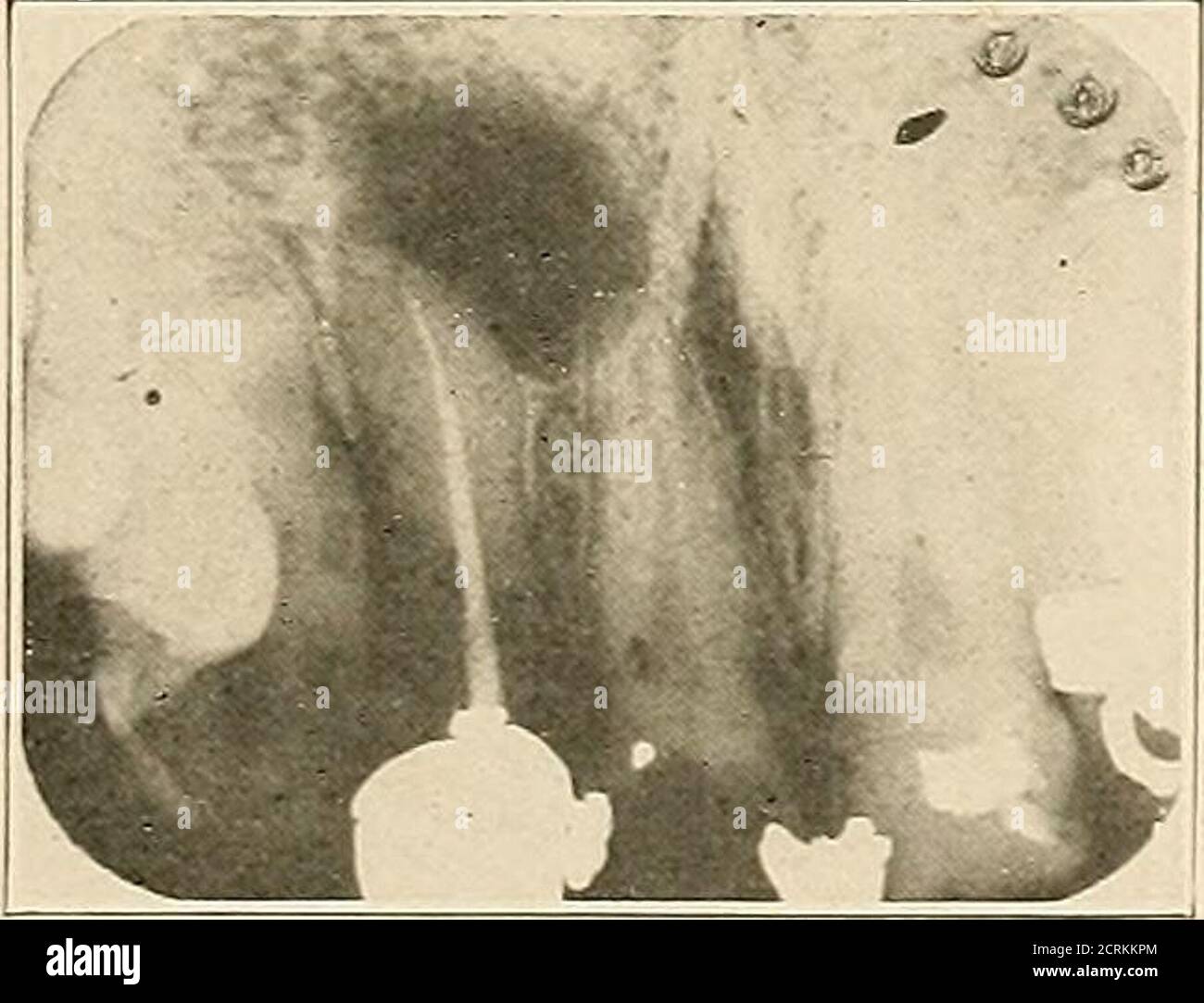 . Interpretation of dental & maxillary roentgenograms . Fig. 216. Fig ...