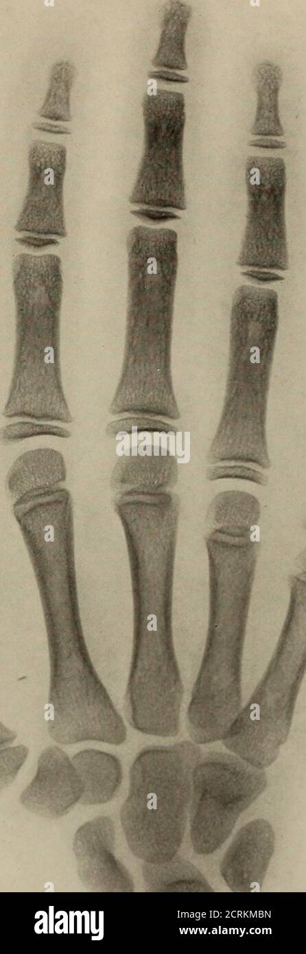 Styloid process of ulna hi-res stock photography and images - Alamy