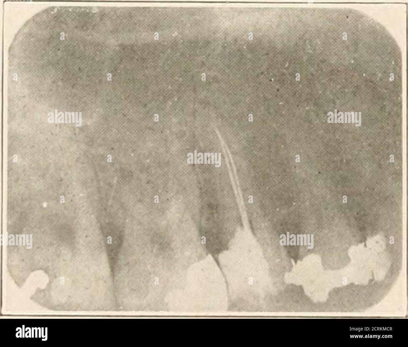 . Interpretation of dental & maxillary roentgenograms . Fig. 212.—-A ...