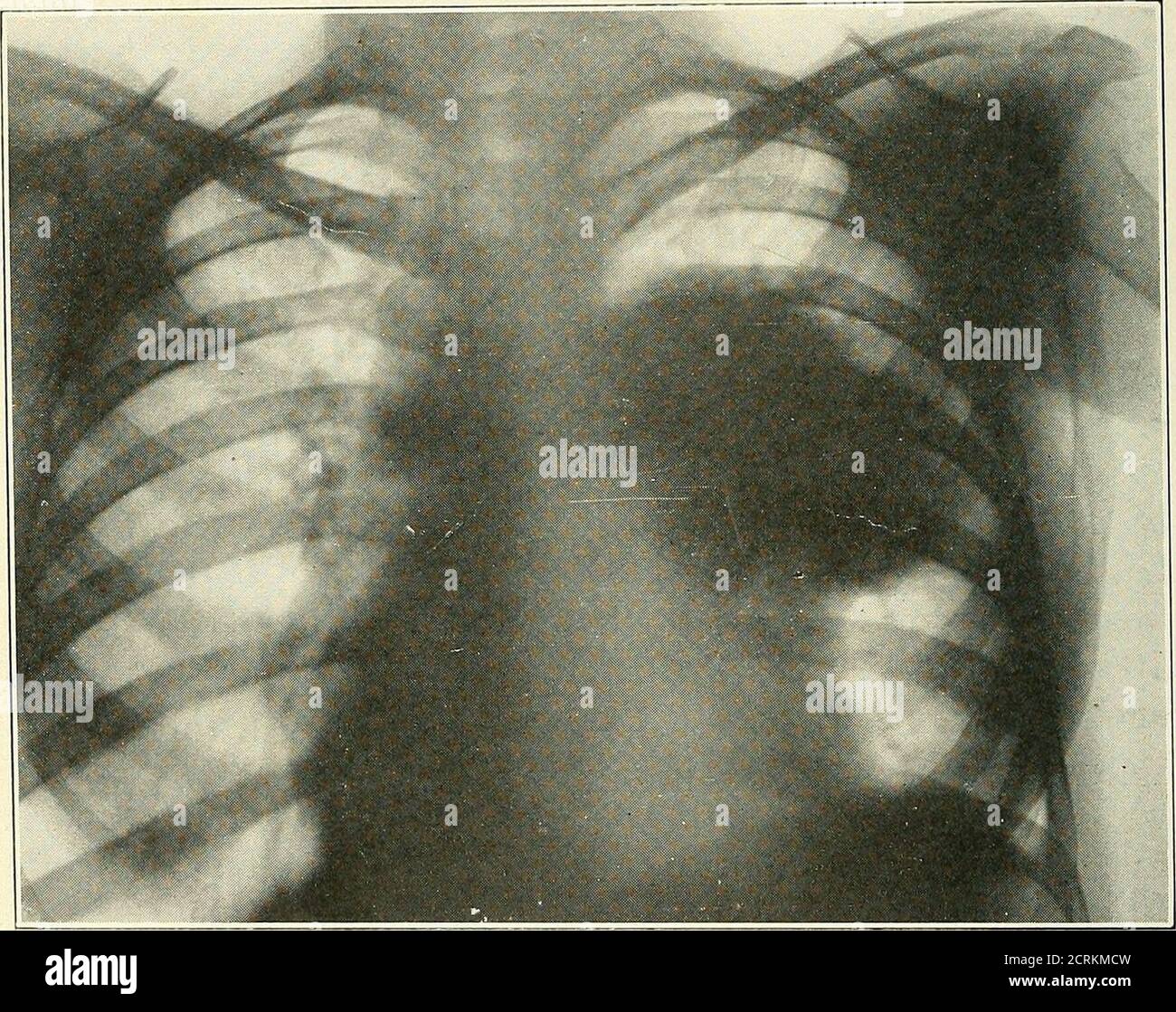 Mediastinal masses hi-res stock photography and images - Alamy