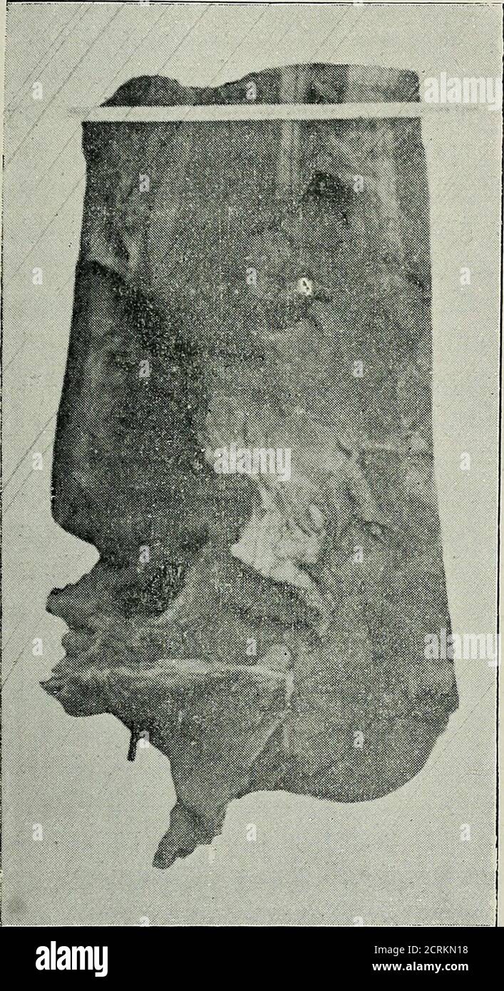 . Diseases of the gall-bladder and bile-ducts, including gall-stones ...