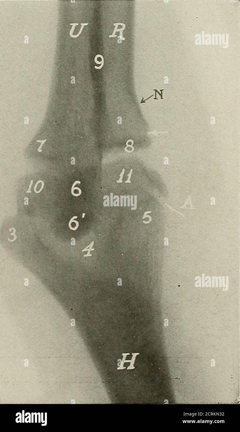 Fracture olecranon process of ulna hi-res stock photography and images ...