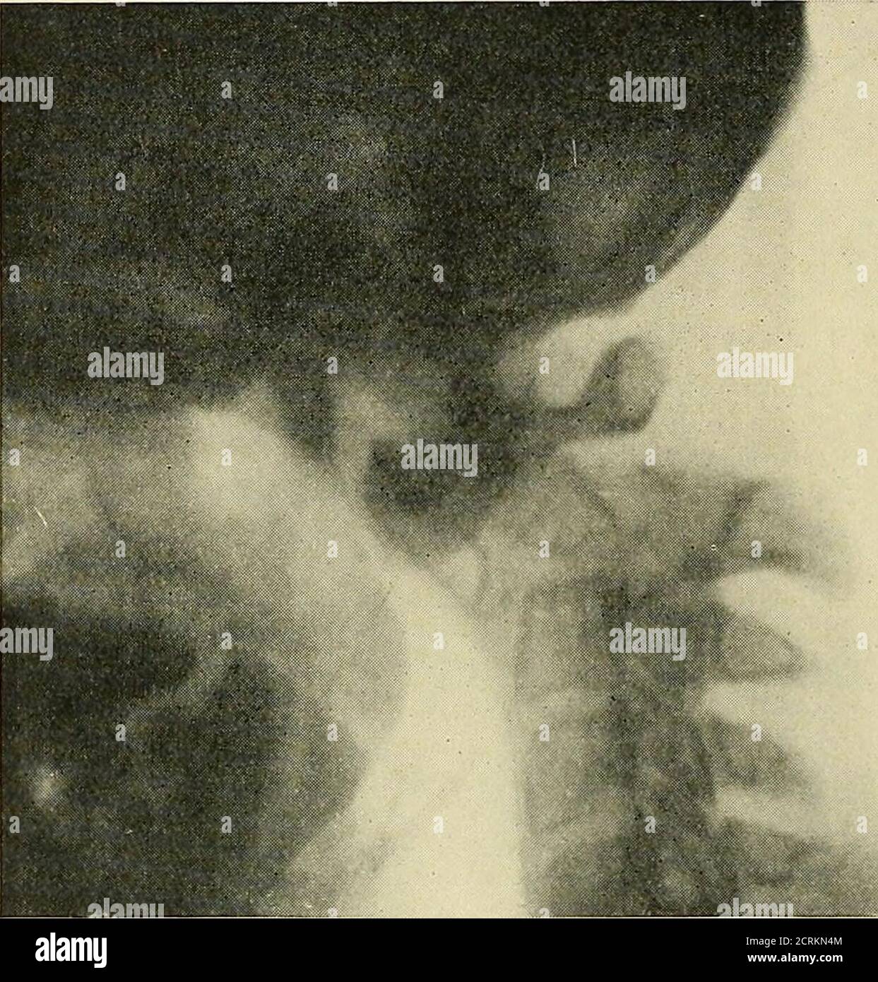 Radium jaw hi-res stock photography and images - Alamy