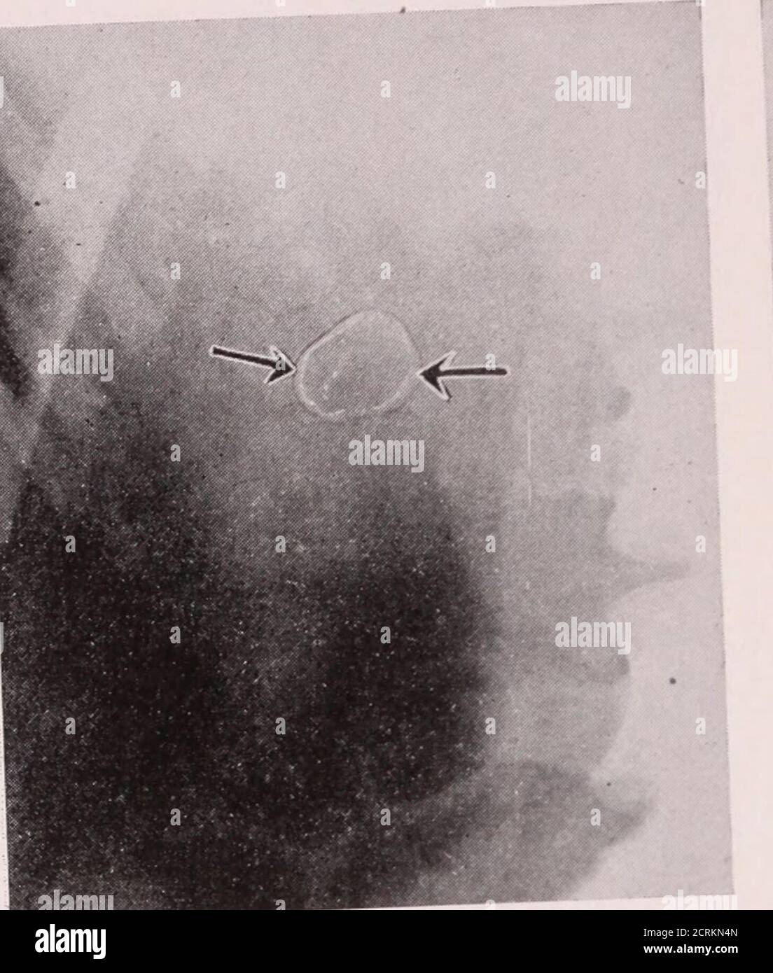 . Journal of radiology . Case No. 3523—Visualized, distendedgallbladder ...