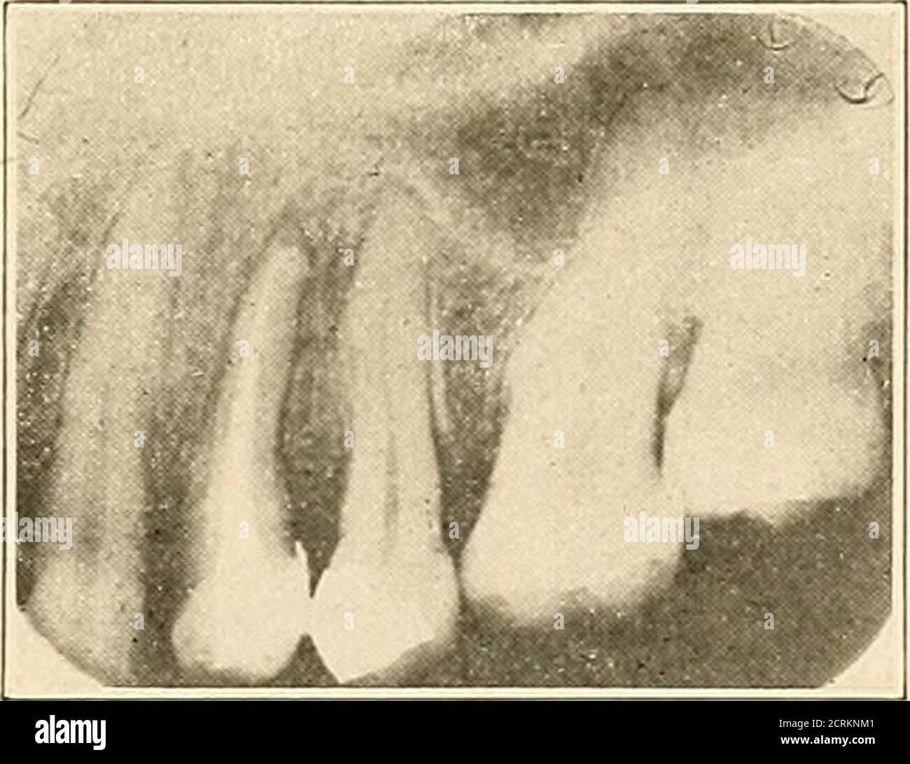 Maxillary first premolar hi-res stock photography and images - Alamy