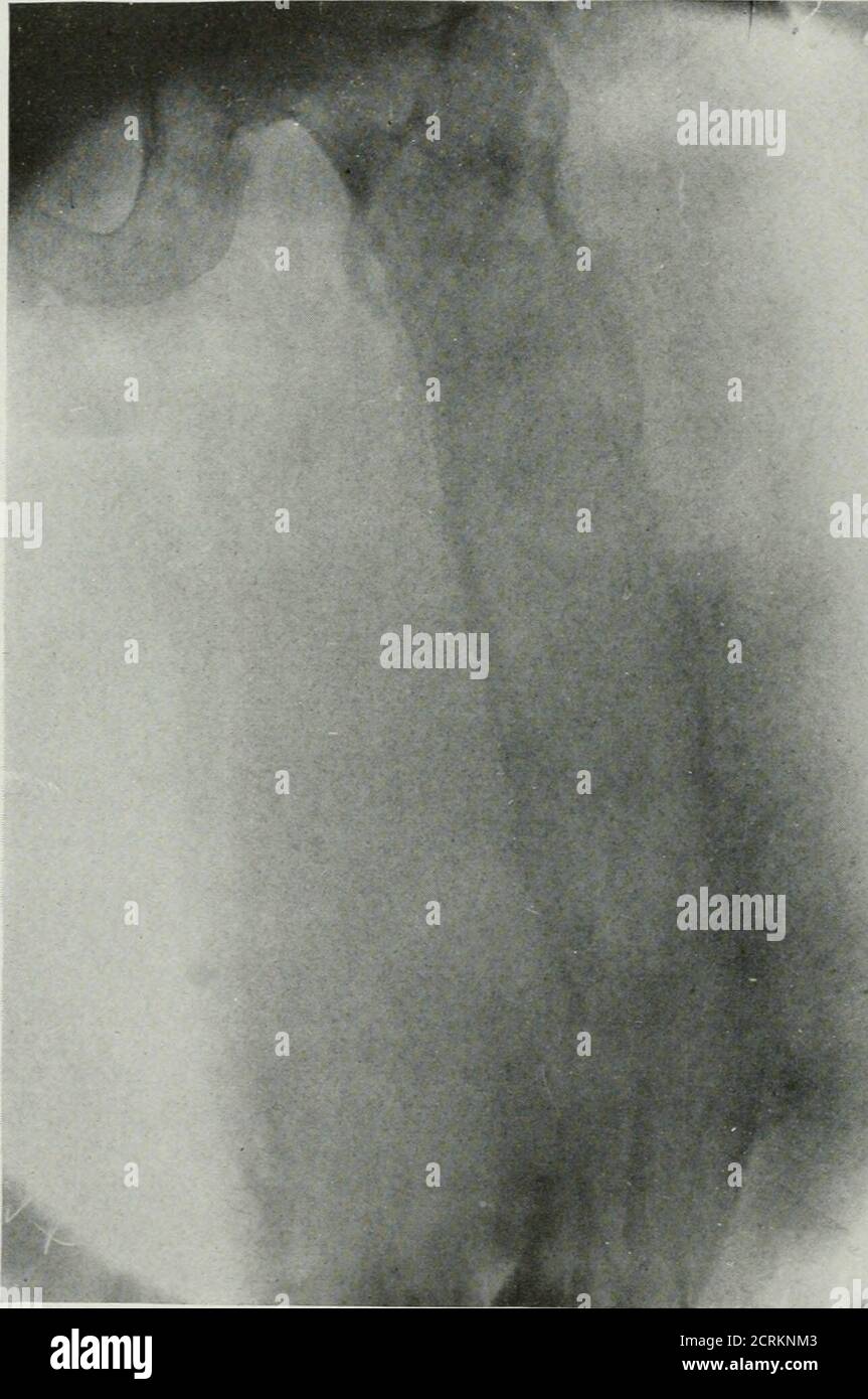 Granulation tissue wound hi-res stock photography and images - Alamy