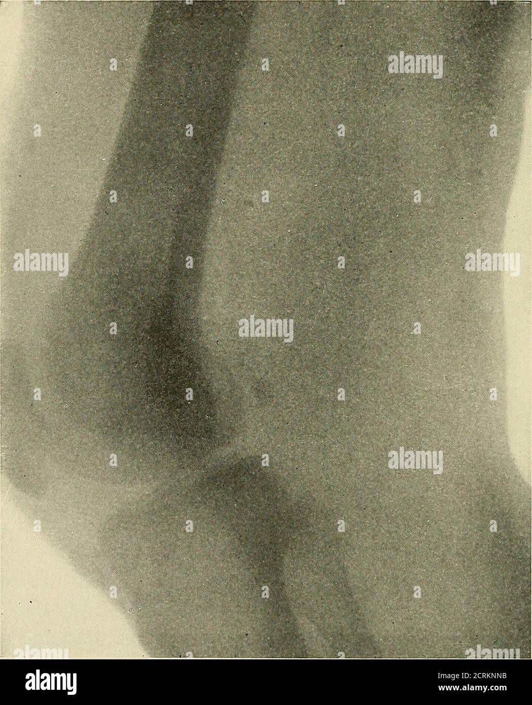 Angiolipoma hi-res stock photography and images - Alamy