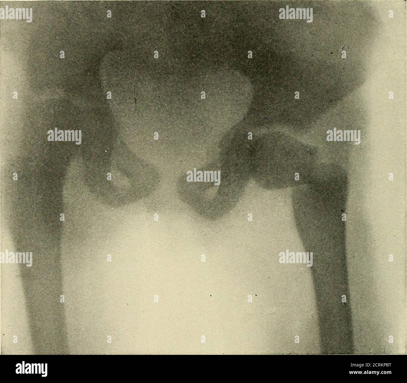 Intracapsular fracture hi-res stock photography and images - Alamy