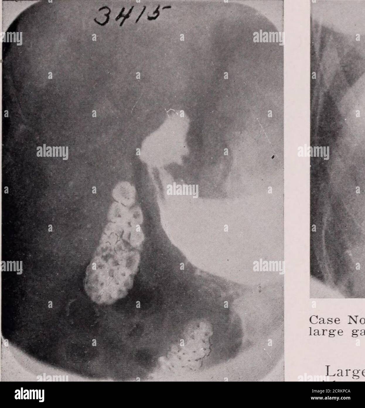 . Journal of radiology . Case No. 1416—One large gall stone isshown ...