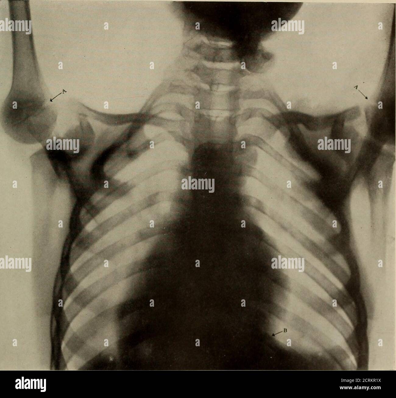 Boy thorax anatomy hi-res stock photography and images - Alamy