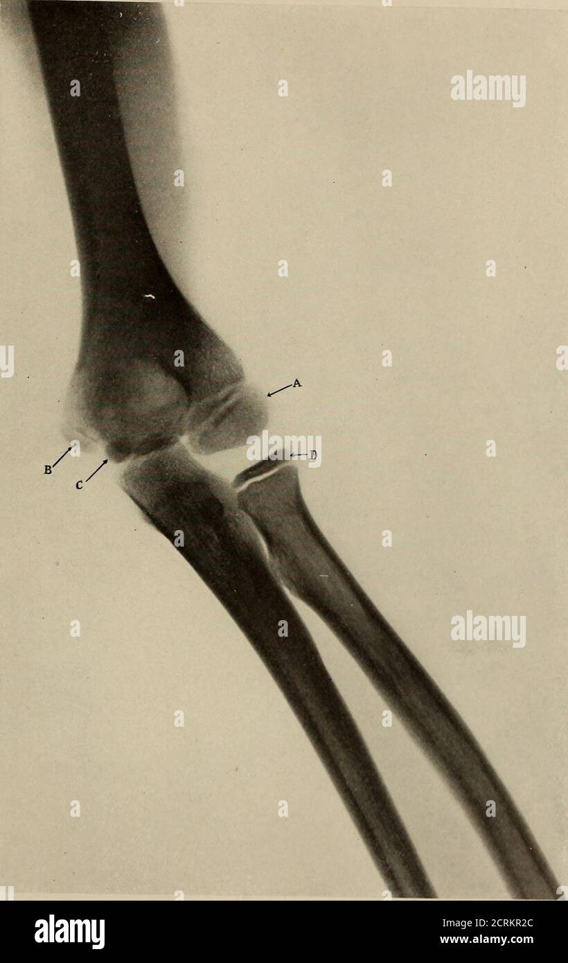 . Living anatomy and pathology; . PLATE 25.NORMAL ELBOW. Age 12 years ...