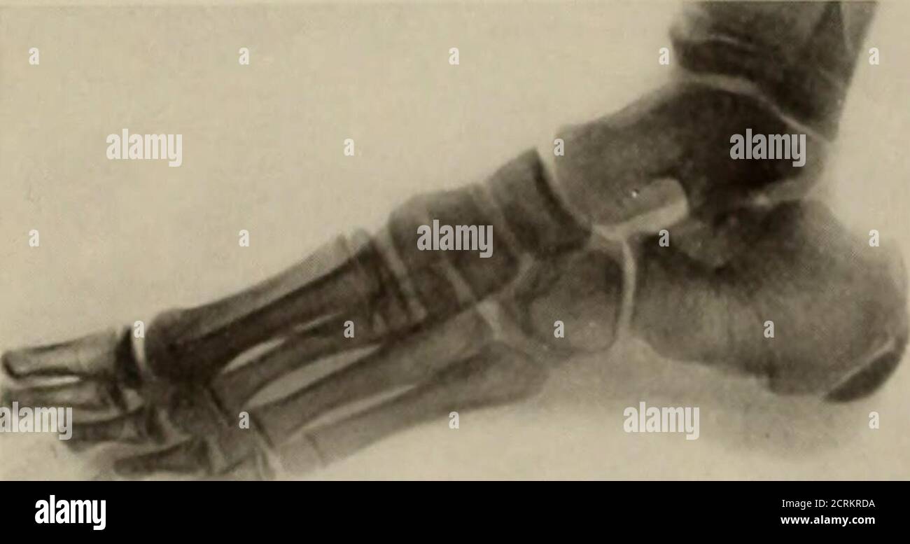. Living anatomy and pathology; . . PLATE 25.NORMAL ELBOW. Age 12 years ...