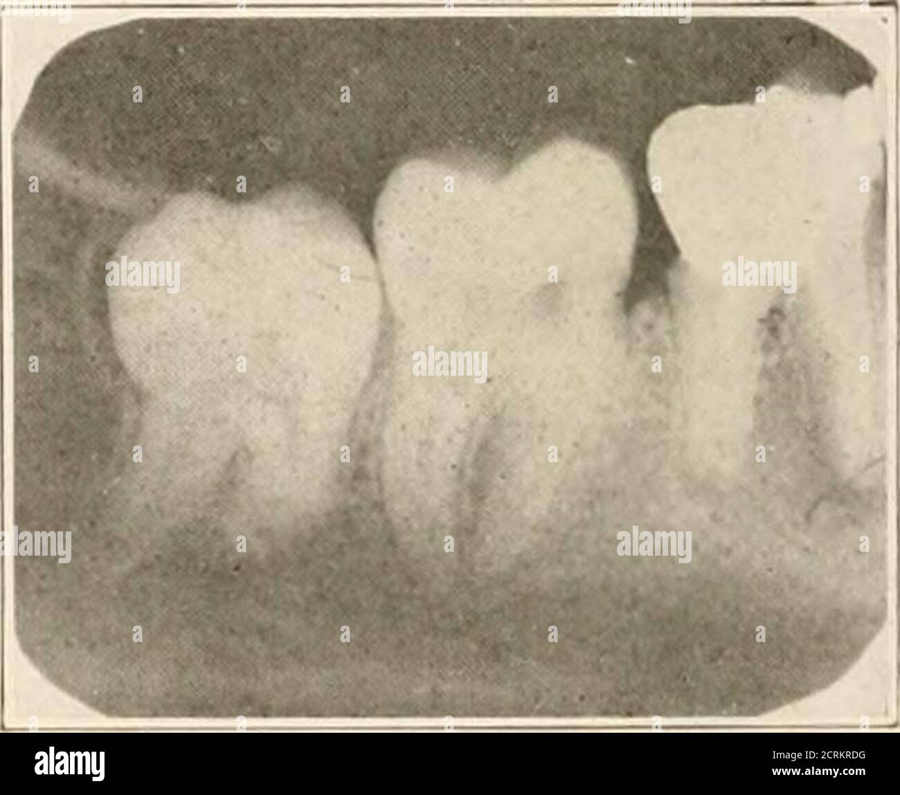 . Interpretation of dental & maxillary roentgenograms . Fig. 204. Fig ...