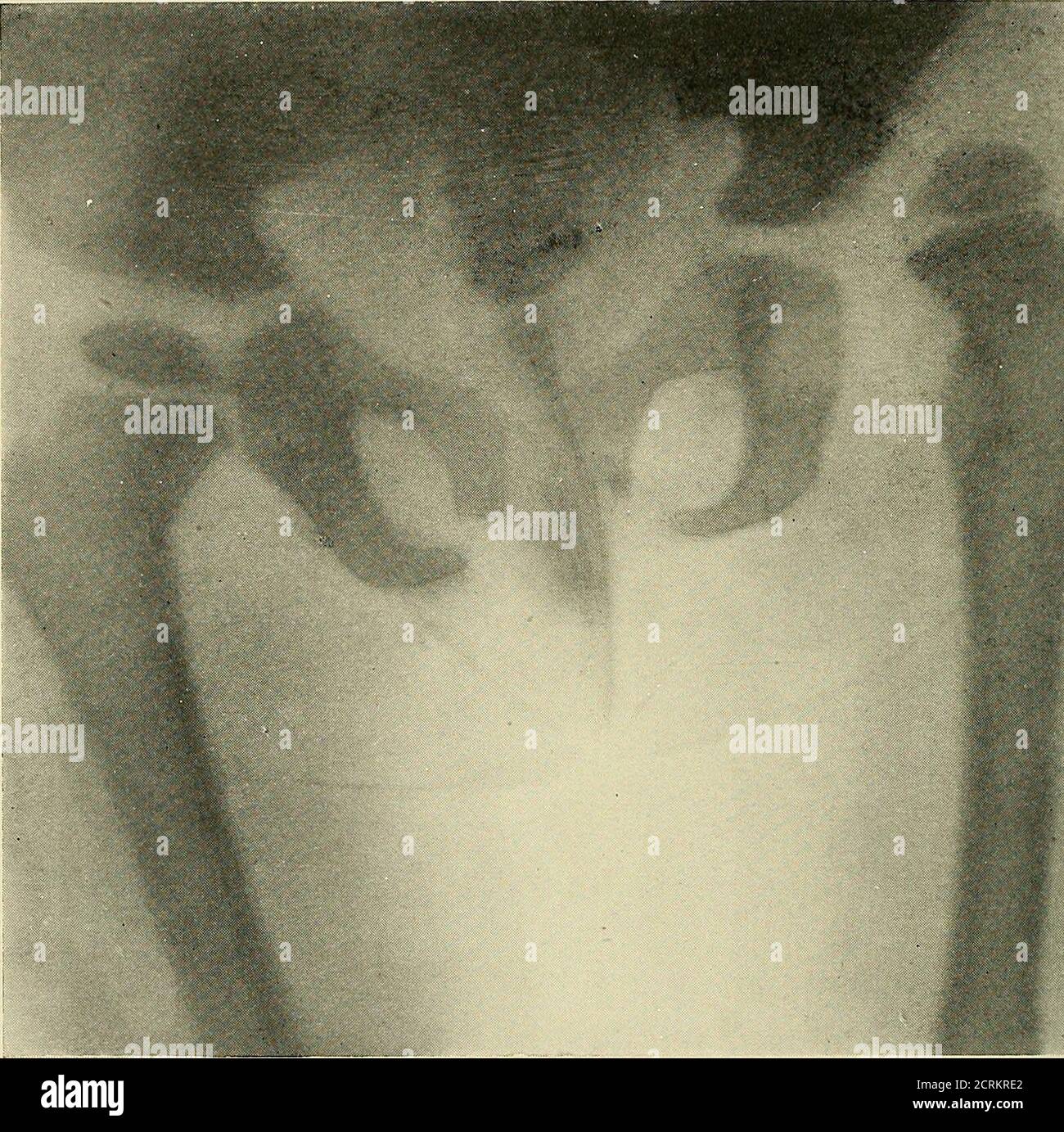 Congenital dislocation of the hips hi-res stock photography and images ...