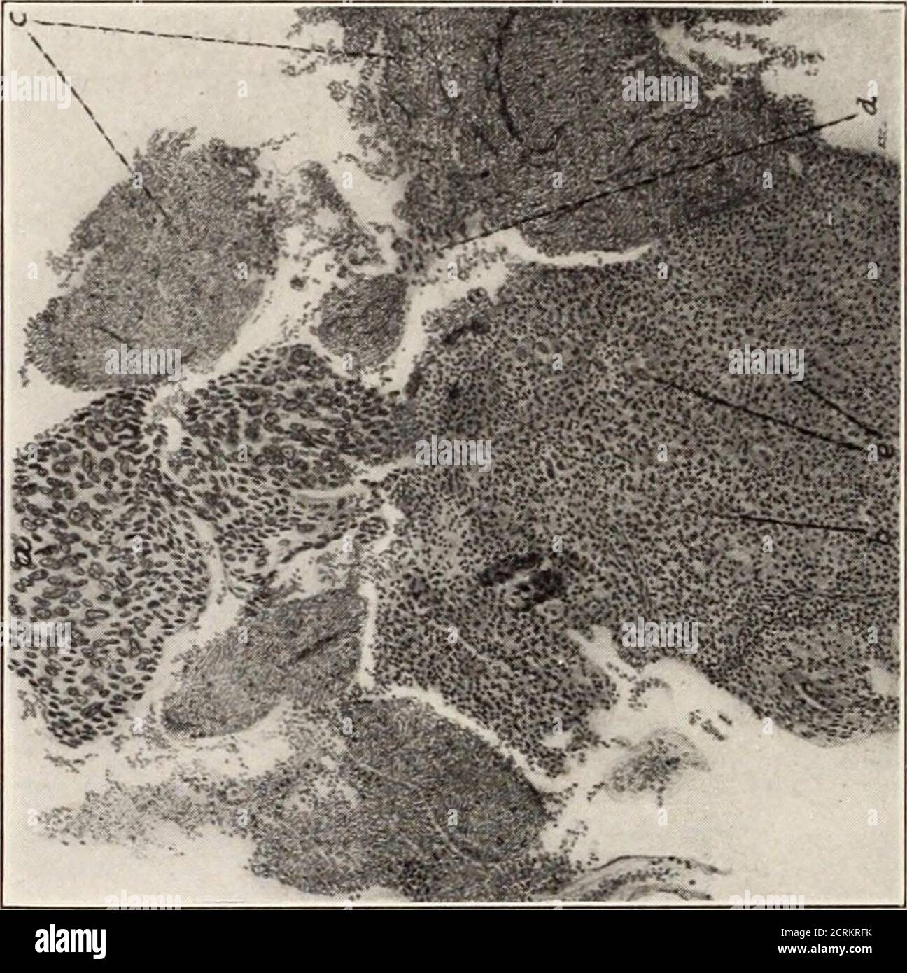 Tuberculous adenitis hi-res stock photography and images - Alamy