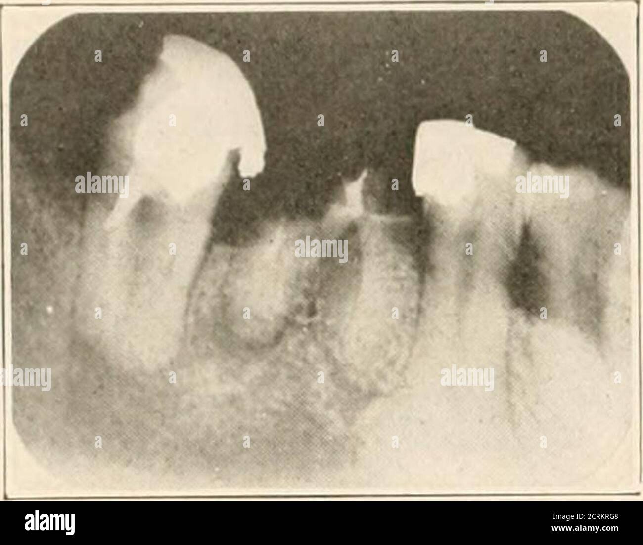 . Interpretation of dental & maxillary roentgenograms . Fig. 200. Fig ...