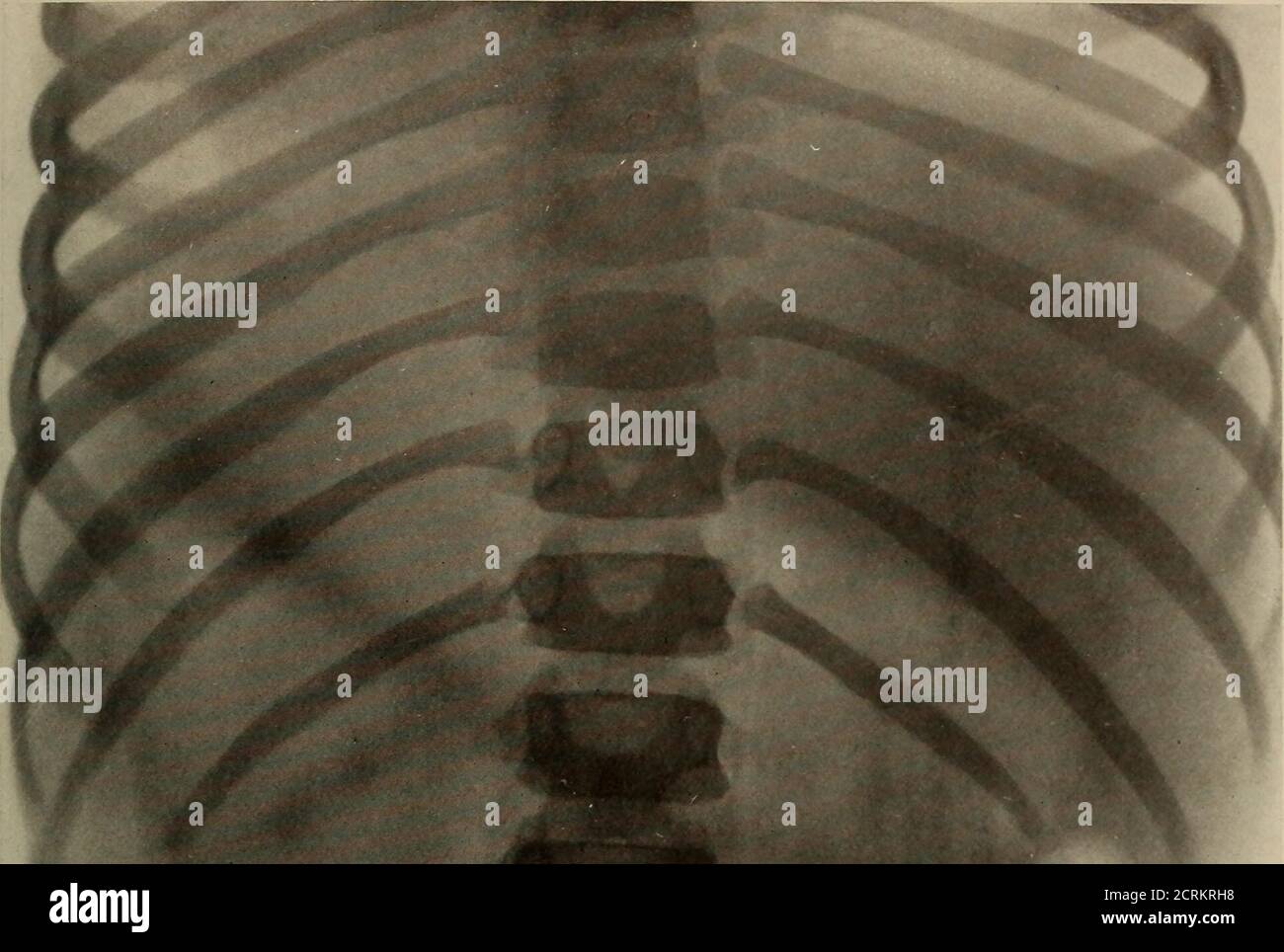 . Living anatomy and pathology; . PLATE 23.NORMAL SPINE. Age 10 years ...