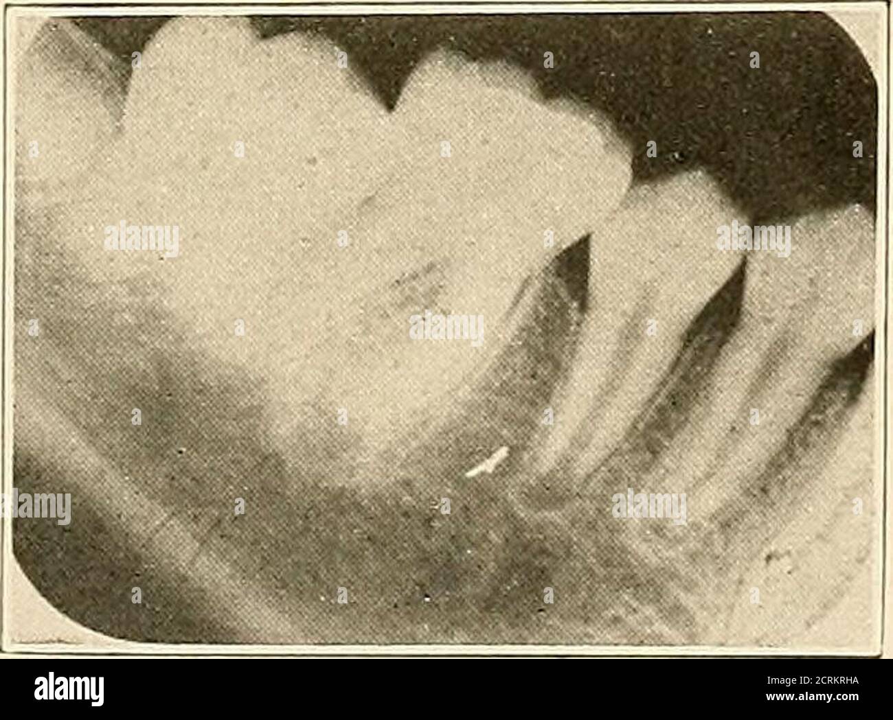 . Interpretation of dental & maxillary roentgenograms . Fig. 200. Fig ...